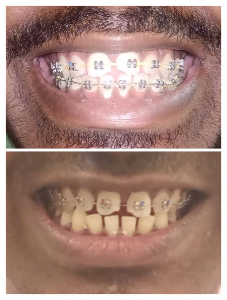 Affordable Invisible Braces Cost in India | Straighten Your Smile Today